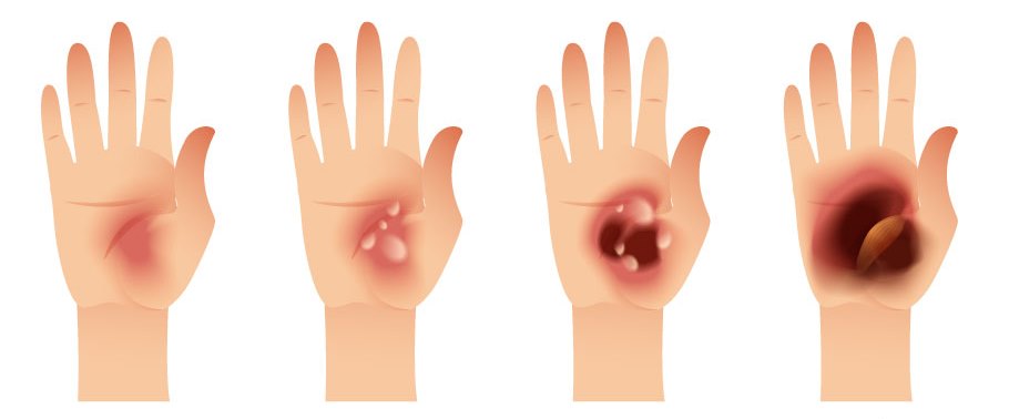 Burns - Urgo Medical healing expert tells you more