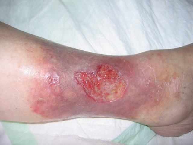 Venous Leg Ulcer - Urgo Healthcare Professionals