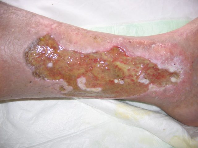 Leg Ulcers - Urgo Medical tells you more about it